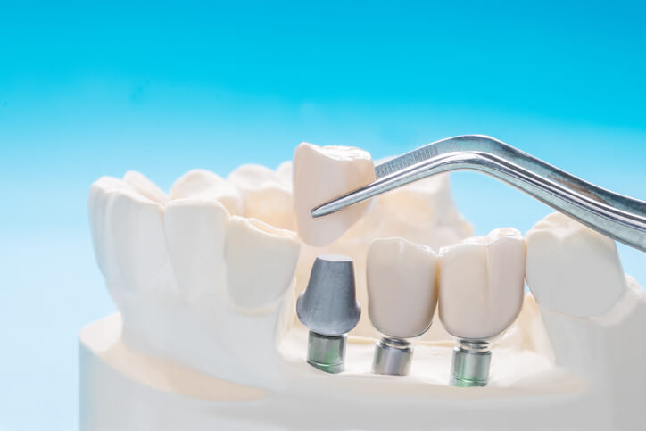 Prostodoncia dental: uso, actuación y prevención | DKV